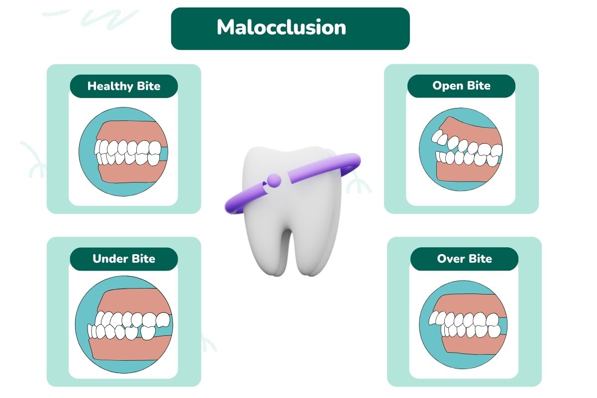 How a Bad Bite Can Impact Oral Health - Jeffrey V. Jones, DDS & Associates